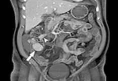Midgut Volvulus Imaging: Overview, Radiography, Computed Tomography
