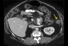 Splenic Abscess Treatment & Management: Approach Considerations ...