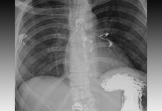Esophageal Atresia (EA) and Tracheoesophageal Fistula (TEF) Imaging and ...