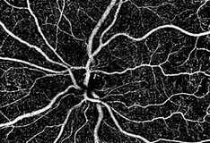 Exudative (Wet) Age-Related Macular Degeneration (AMD): Practice ...
