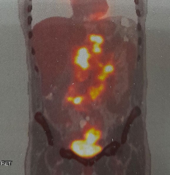 Abdominal Pain and Hematemesis - Page 2