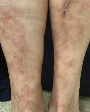 Persistent, Painful Lower-Extremity Nodules - Page 2