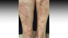 Livedo Reticularis
