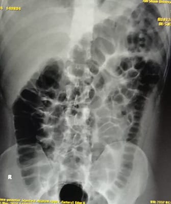 Persistent Vomiting and Abdominal Pain After Sleeve Gastrectomy - Page 4