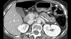 Pancreatic Cancer Staging: TNM Classification for Pancreatic Cancer