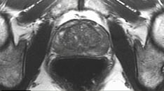 Prostate Cancer Staging: TNM Classification for Prostate Cancer