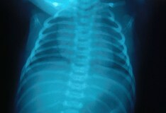Proglycem (diazoxide) dosing, indications, interactions, adverse ...