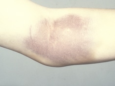 Coagadex (Factor X, human) dosing, indications, interactions, adverse ...