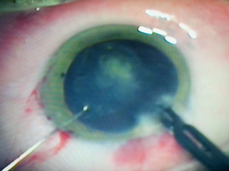 American Society of Cataract and Refractive Surgery (ASCRS) 2017 Annual ...