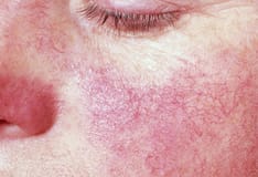 Benlysta (belimumab) dosing, indications, interactions, adverse effects ...