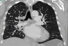 Video-Assisted Thoracoscopic Surgery (VATS): Background, Indications ...