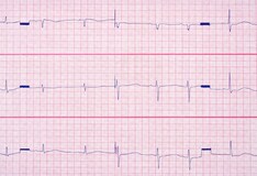 Paroxysmal Supraventricular Tachycardia: Background, Etiology, Epidemiology
