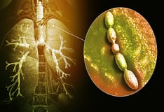 Fungal Pneumonia: Overview of Fungal Pneumonia, Risk Factors ...