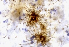 Progressive Supranuclear Palsy: Practice Essentials, Background ...