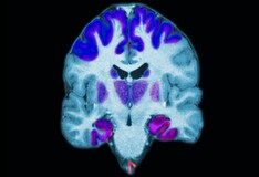 Functional MRI Shows Brain Damage From Lead Poisoning in Early Childhood