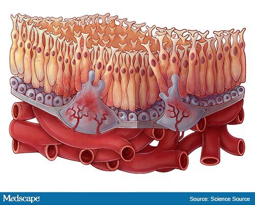 Fast Five Quiz: Exudative Age-Related Macular Degeneration (Wet AMD ...