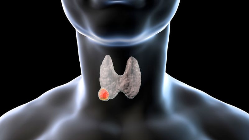 Thyroid Cancer Center Of Excellence Medscape