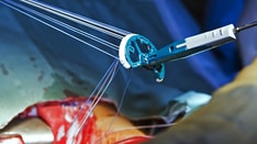 Sternotomy: Overview, Preparation, Technique