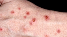 Prurigo Nodularis: Practice Essentials, Pathophysiology, Etiology