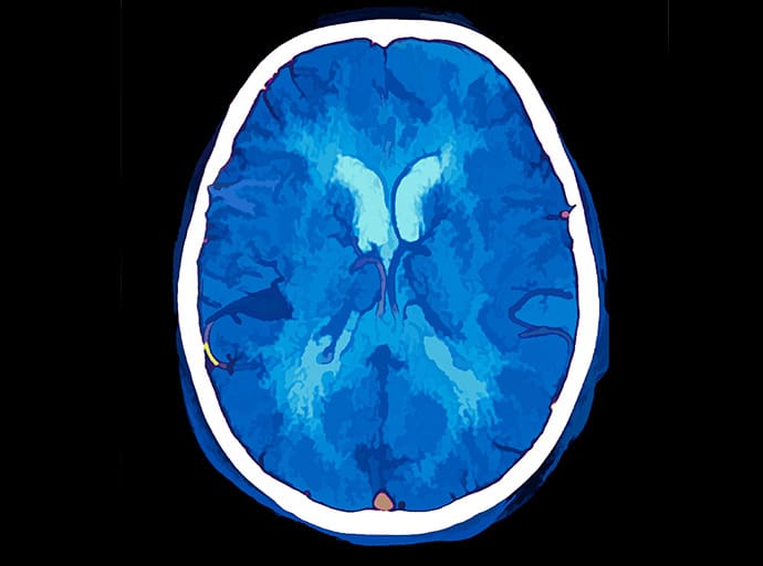 Positional Headaches in a Patient With Acne - Page 4