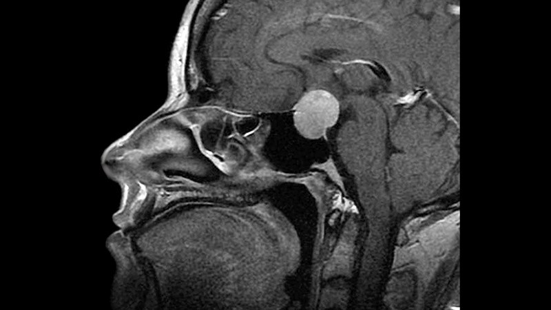 Multiple Sclerosis Center of Excellence | Medscape