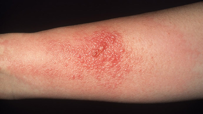 A Rash That Keeps Moving - Page 4