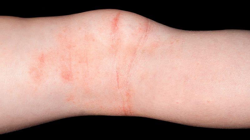 A 17-Year-Old With a Vacation Rash - Page 6