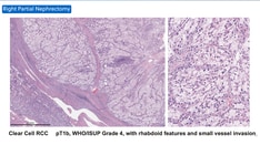 Renal Cell Carcinoma Staging: TNM Classification for Renal Cell Carcinoma