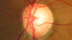 Xalatan, Xelpros (latanoprost) dosing, indications, interactions ...