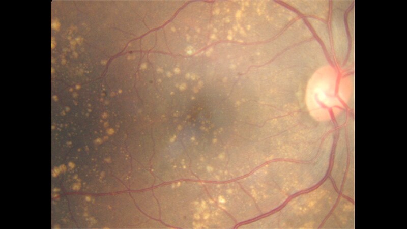 AMD and Retinal Disease | Medscape