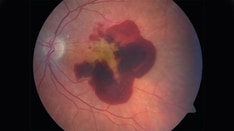 Nonexudative (Dry) Age-Related Macular Degeneration (AMD): Practice ...