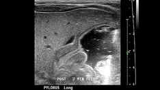Procanbid, Pronestyl (procainamide) dosing, indications, interactions ...