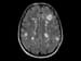 FDA Approves Siponimod (Mayzent) for Multiple Sclerosis
