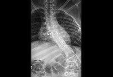 Optic Atrophy: Background, Pathophysiology, Epidemiology