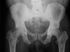 Xofigo (radium-223 dichloride) dosing, indications, interactions ...