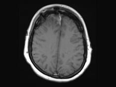 Dotarem (gadoterate meglumine) dosing, indications, interactions ...