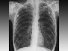 Parapneumonic Pleural Effusions and Empyema Thoracis: Background ...