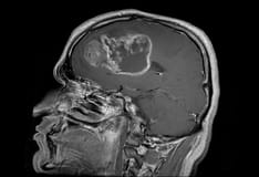 Imaging in Glioblastoma Multiforme: Overview, Radiography, Computed ...
