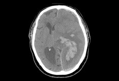 TNK tPA, TNKase (tenecteplase) dosing, indications, interactions ...