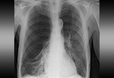 Bullectomy Technique: Approach Considerations, Removal of Lung Bulla ...