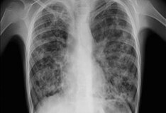 Pseudomonas Infection Clinical Presentation: History, Physical, Causes