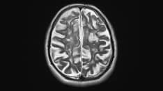 Mayzent (siponimod) dosing, indications, interactions, adverse effects ...