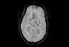 Disseminated Intravascular Coagulation Workup: Approach Considerations ...