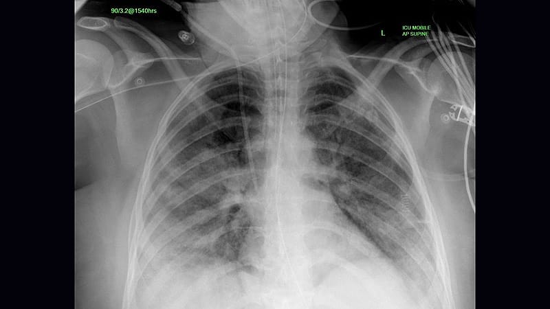 Mechanical Ventilation | Medscape