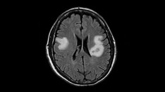 Brain Abscess Treatment & Management: Approach Considerations, Medical ...