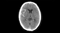Subarachnoid Hemorrhage Treatment & Management: Approach Considerations ...
