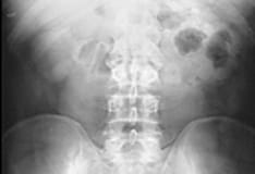 Cecal Volvulus Imaging: Overview, Radiography, Computed Tomography