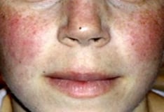 Autoimmune Antibodies: Autoantibodies