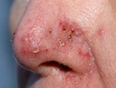 ss-chemotherapy-lesions
