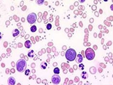 ss-chronic-leukemia